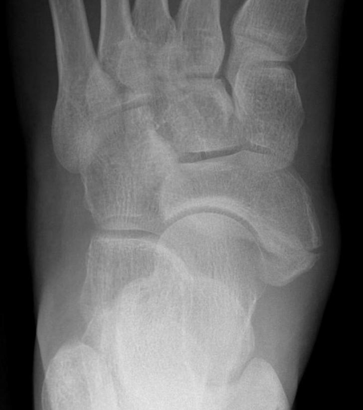 Accessory Navicular | The Bone School